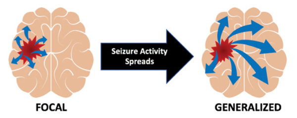 Traumatic Brain Injury, Seizures, and Epilepsy - Brain Injury ...